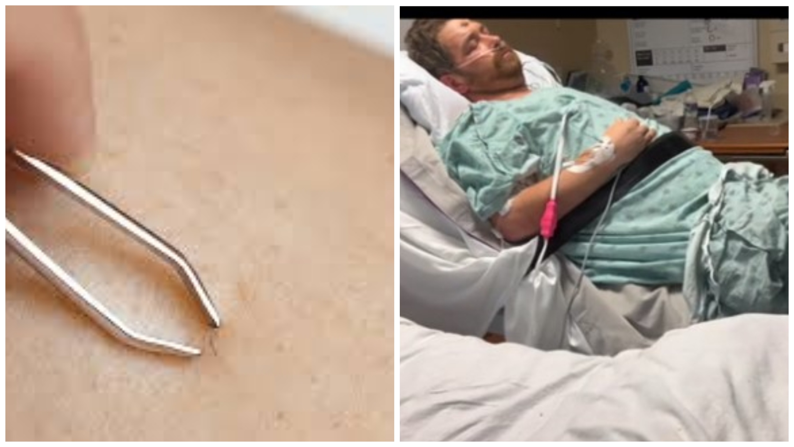 Si toglie pelo incarnito dall'inguine e va in coma profondo