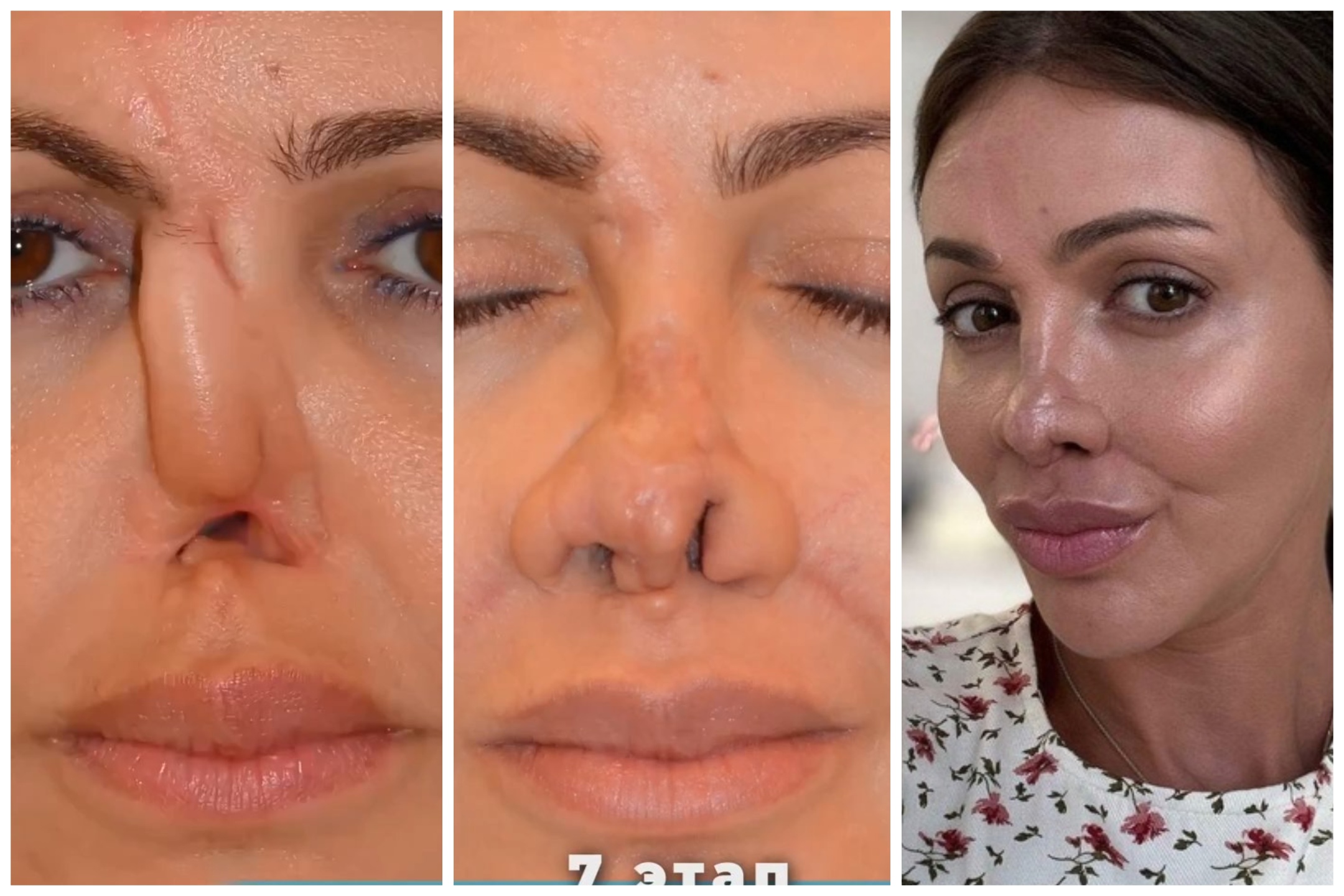 Die Ex-Frau des Fußballers Arshavin verliert ihre Nase durch Nekrose: von Chirurgen wieder aufgebaut