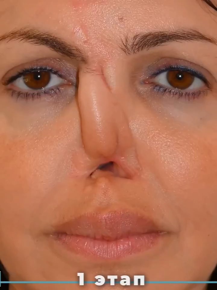 Die Ex-Frau des Fußballers Arshavin verliert ihre Nase durch Nekrose: von Chirurgen wieder aufgebaut