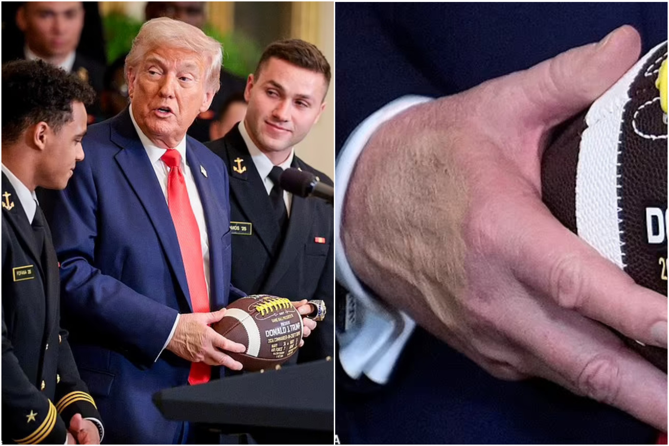 Donald Trump et le retour de son ecchymose à la main : qu'est-ce qui se ...